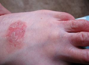 Itchy Dry Skin Patches On Body, Face and Hands - Skin Disease Remedies